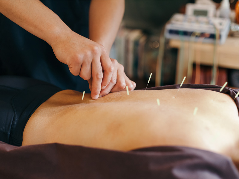 Acupuncture in Maitland - Insight Chiropractic Health and Wellness ...